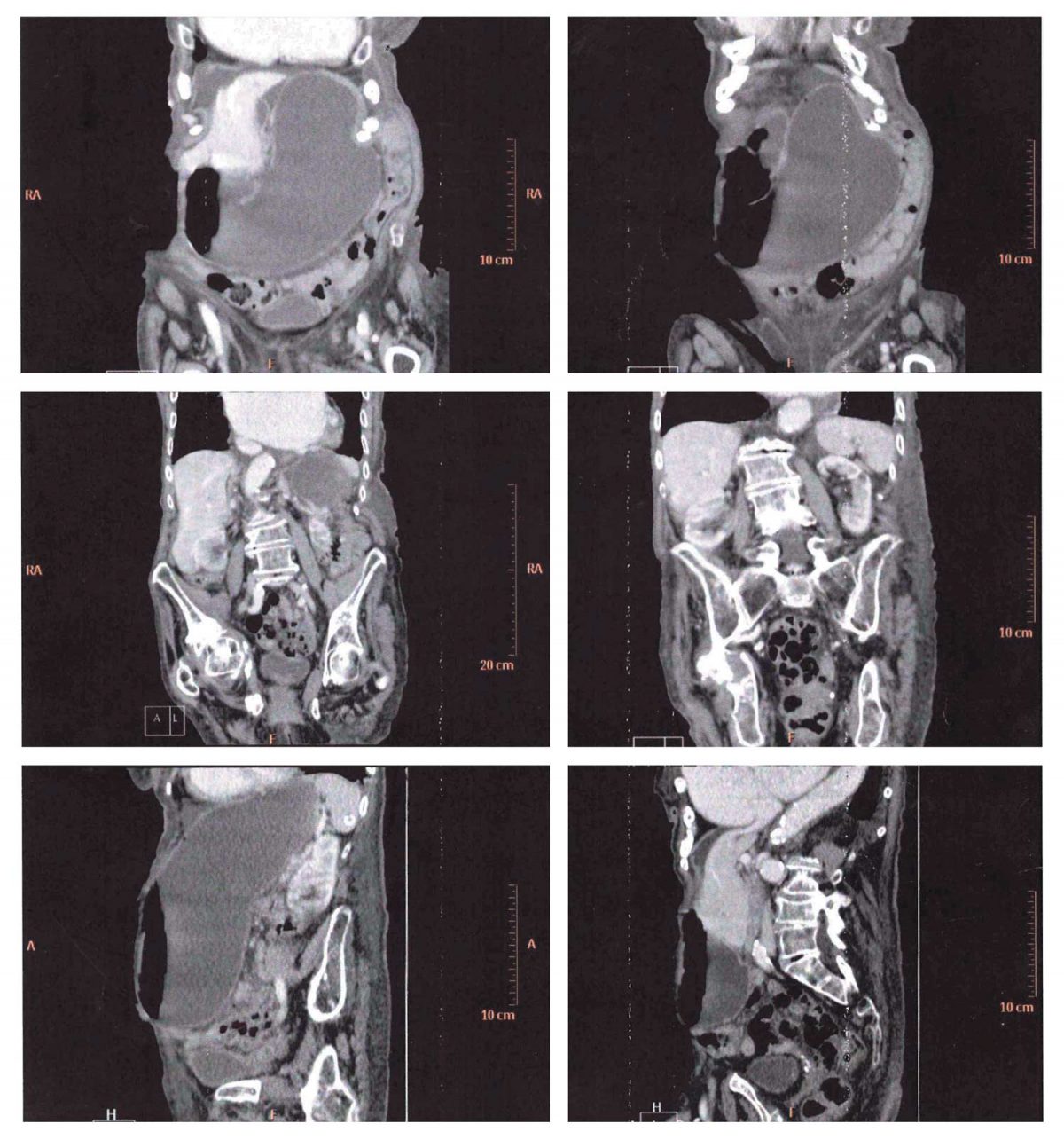 Archives des Occlusion intestinale - Repères en Gériatrie